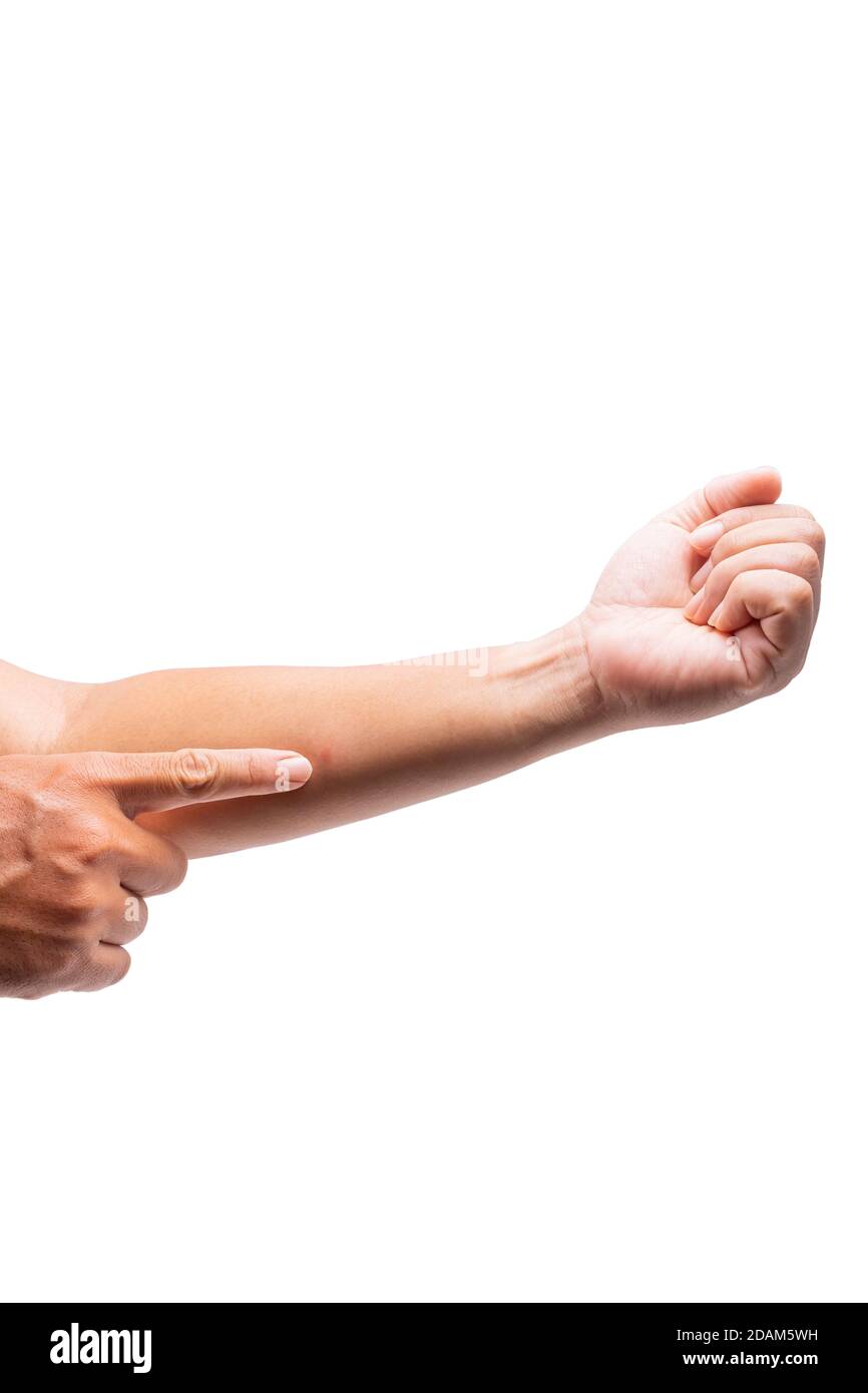 Swollen insect bites Cut Out Stock Images & Pictures - Alamy