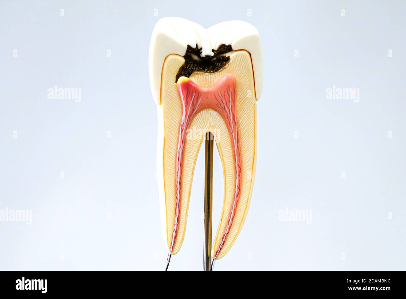 Tooth decay model Stock Photo - Alamy