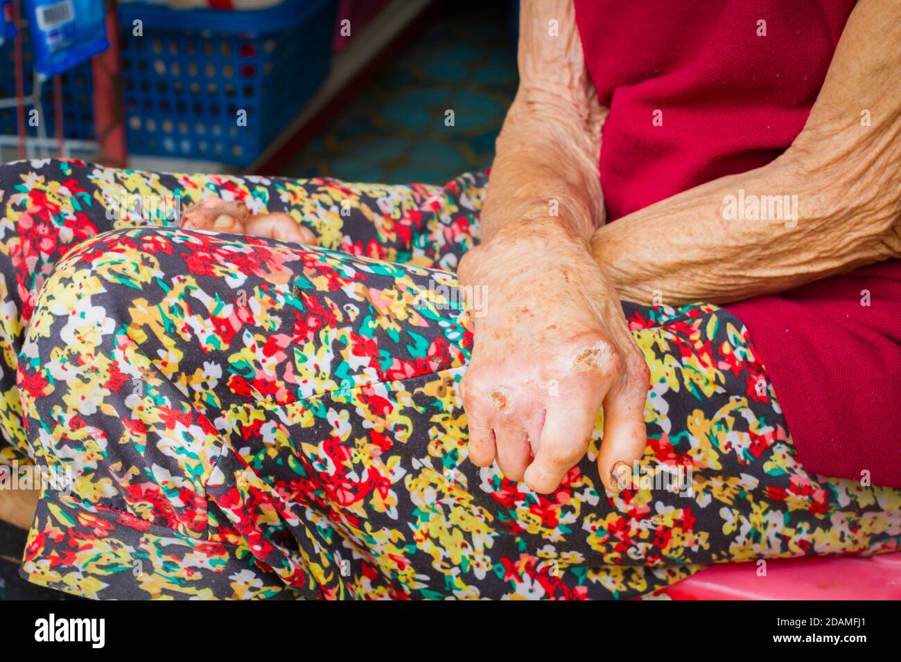 Leprosy hands hi-res stock photography and images - Alamy