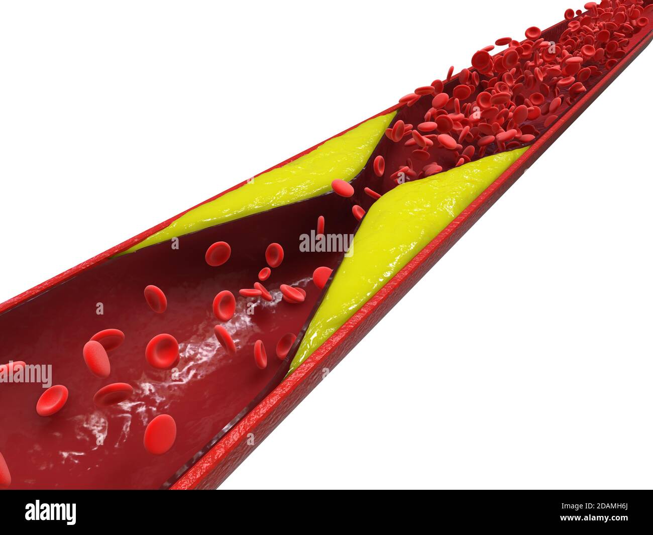 3d rendering atherosclerosis with cholesterol blood or plaque in vessel ...