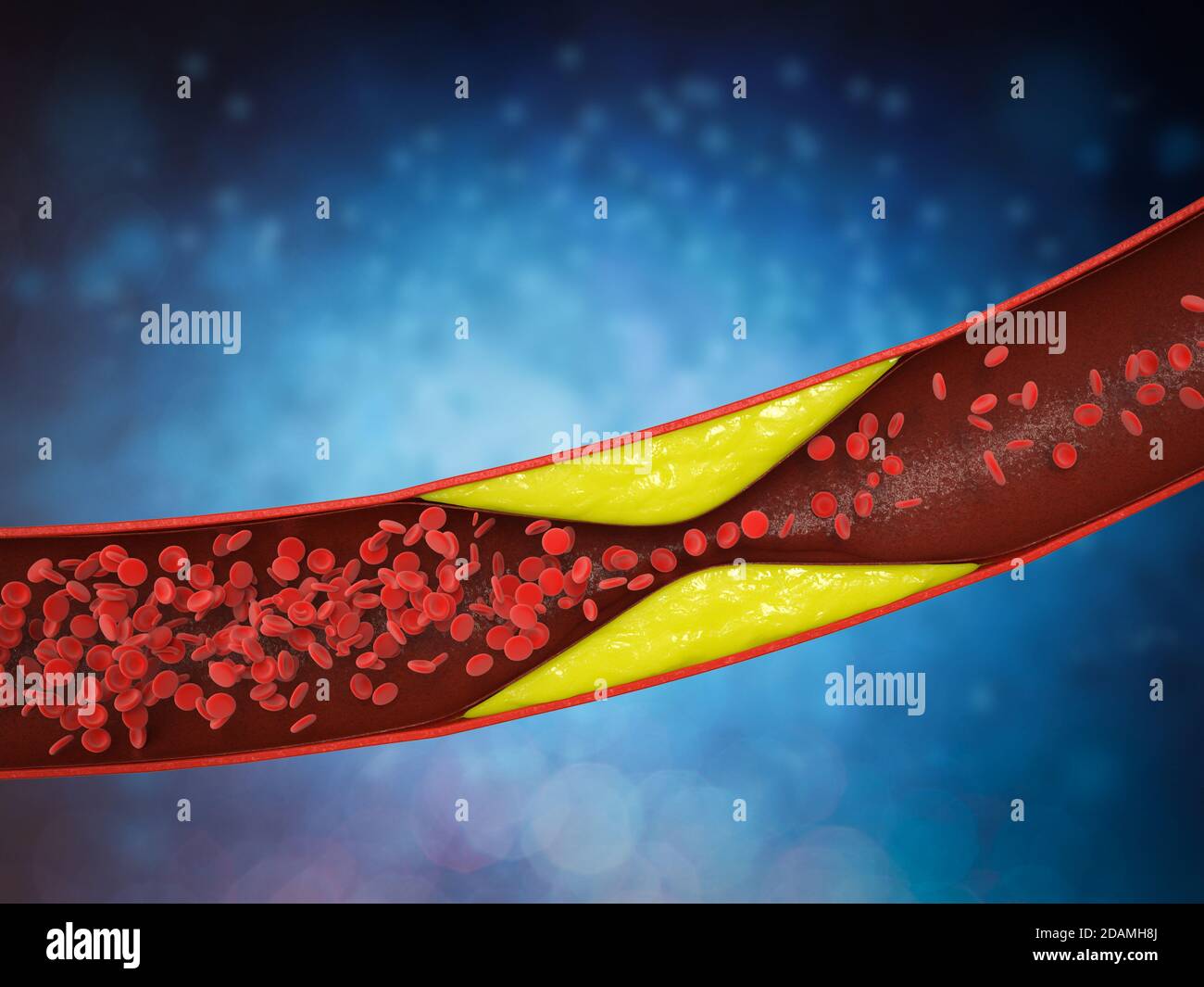 3d rendering atherosclerosis with cholesterol blood or plaque in vessel ...