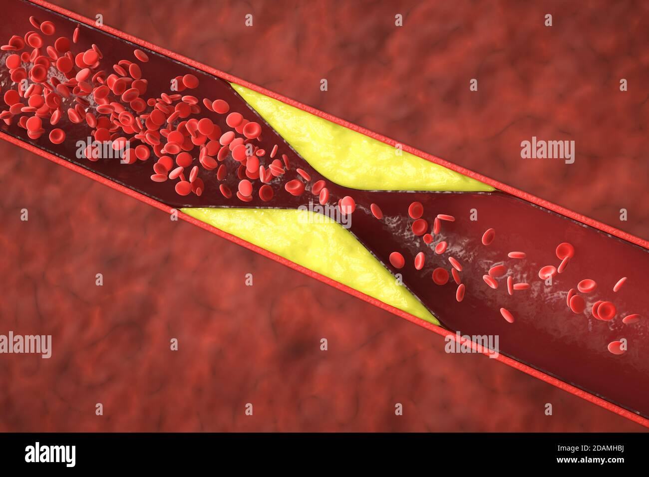 Atherosclerosis plaque hi-res stock photography and images - Alamy