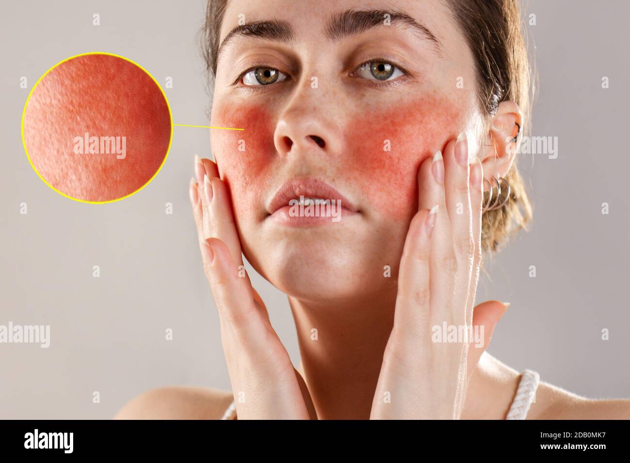 Cosmetology and rosacea. A young woman holds her hands to her reddened ...