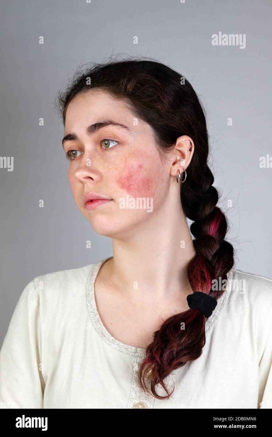 Portrait of a young Caucasian woman showing redness and inflamed blood ...