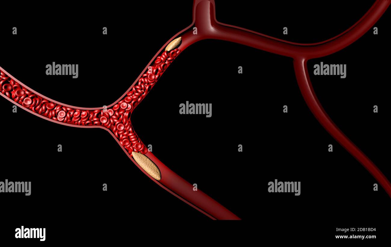 3d clot thrombus for medical health on black 3d render Stock Photo - Alamy