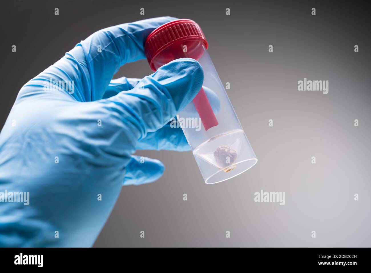 Doctor Hand With Plastic Container Sampling Of Feces Stock Photo - Alamy