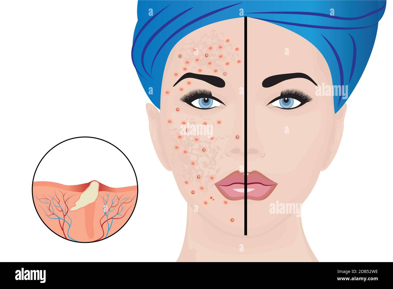 Acne pustules on a woman face and a treatment result before and after ...