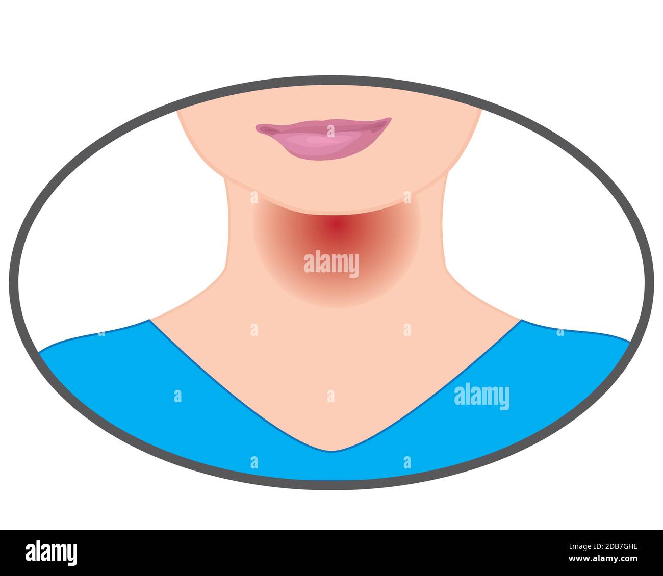 Sore throat because of flu virus influenza inspiratory infection vector ...