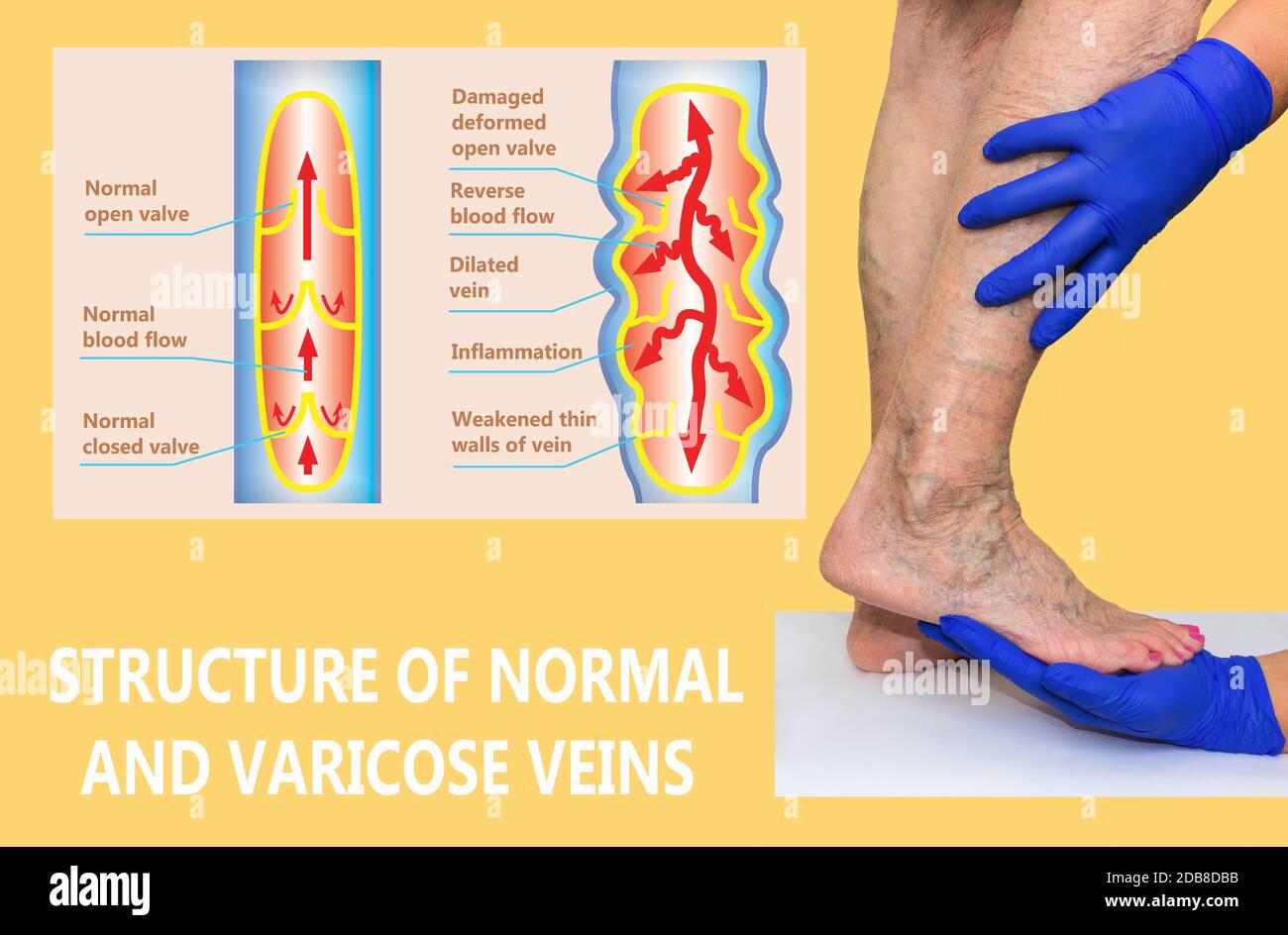 Varicose veins on a female senior legs. The structure of normal and ...