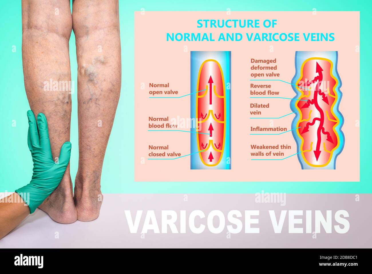 Varicose veins on a female senior legs. The structure of normal and ...