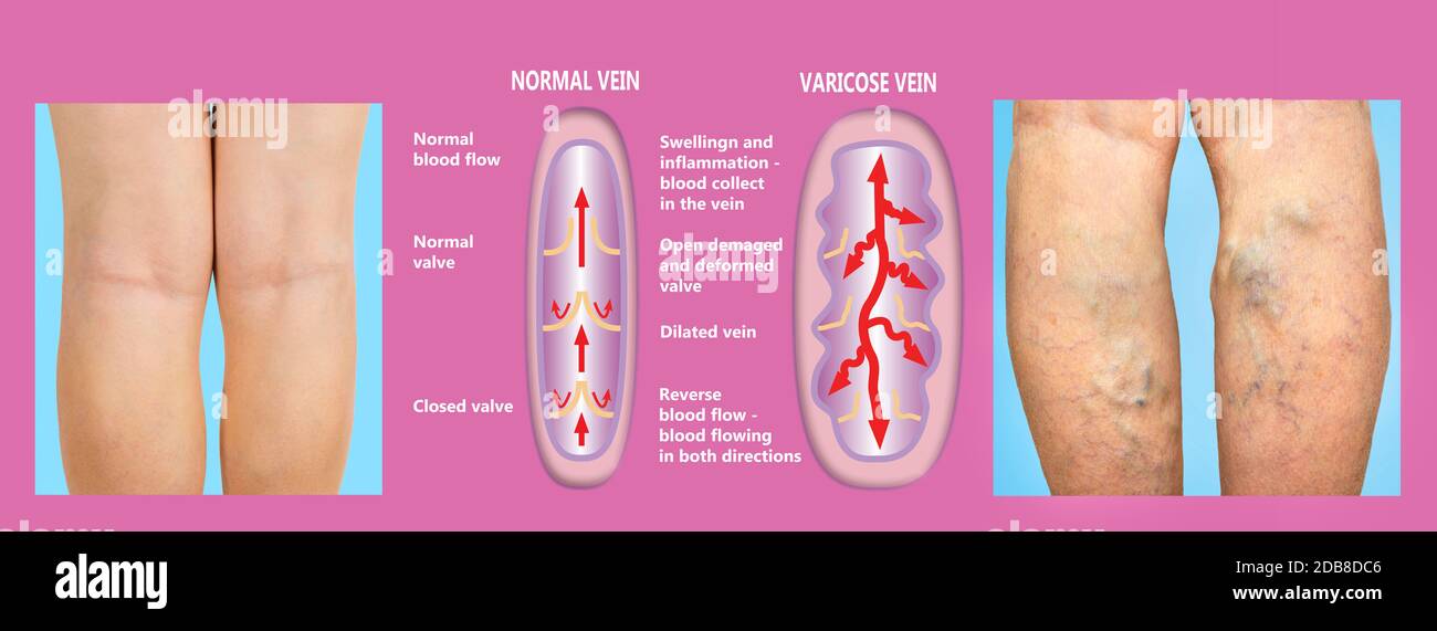 Varicose veins on a female senior legs. The structure of normal and ...