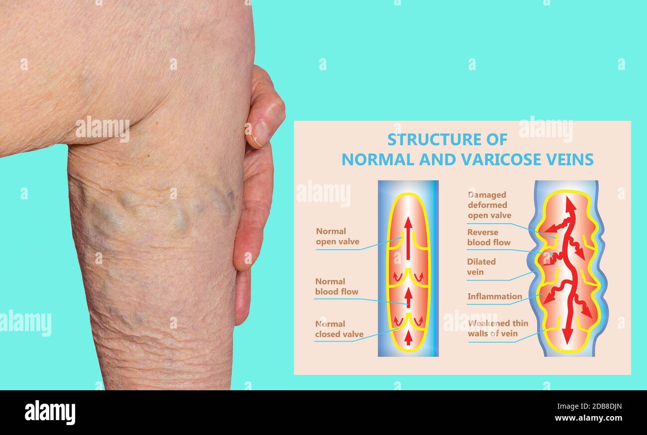 Varicose veins on a female senior legs. The structure of normal and ...