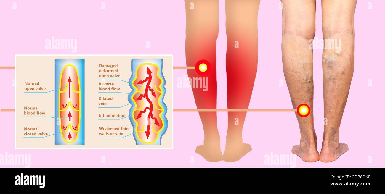 Varicose veins on a female senior legs. The structure of normal and ...