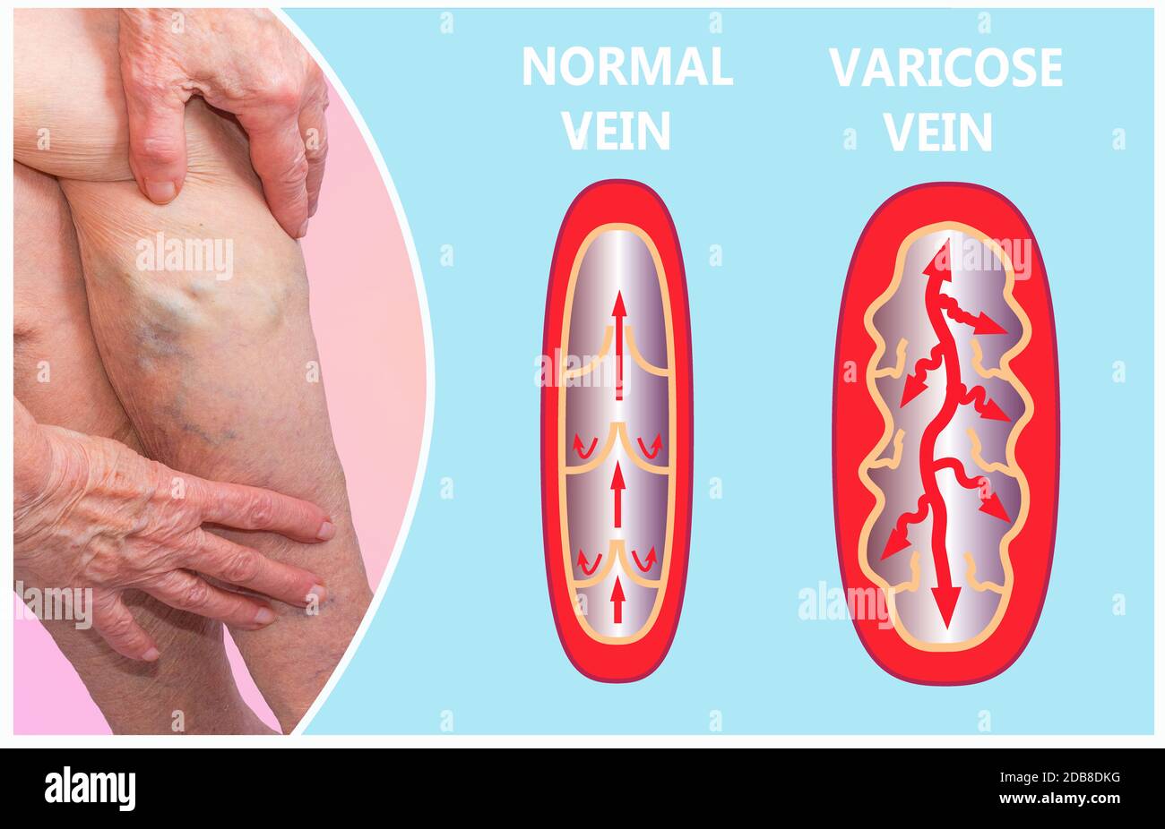 Varicose veins on a female senior legs. The structure of normal and ...