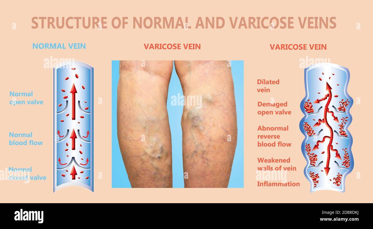 Varicose veins on a female senior legs. The structure of normal and ...