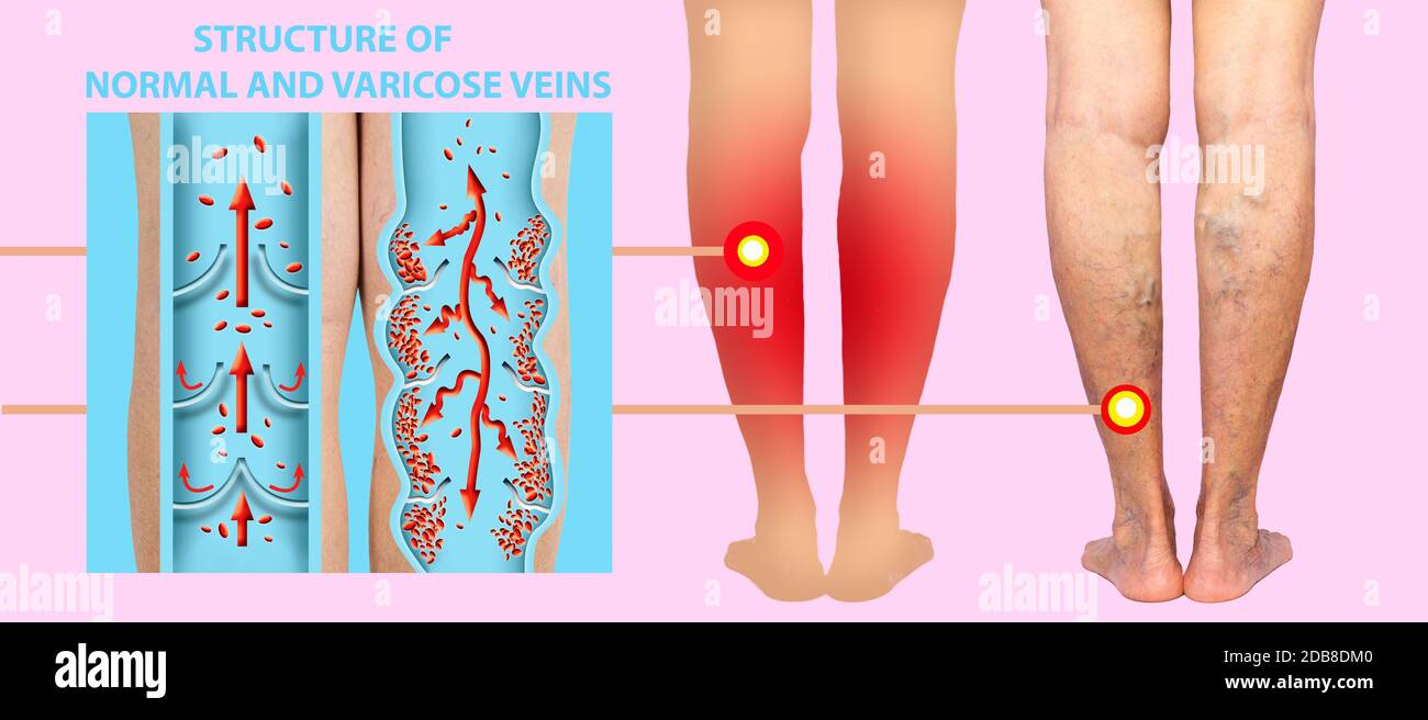 Varicose veins on a female senior legs. The structure of normal and ...
