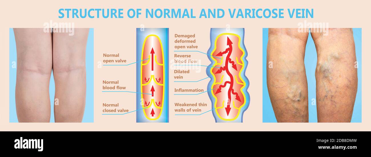 Varicose veins on a female senior legs. The structure of normal and ...