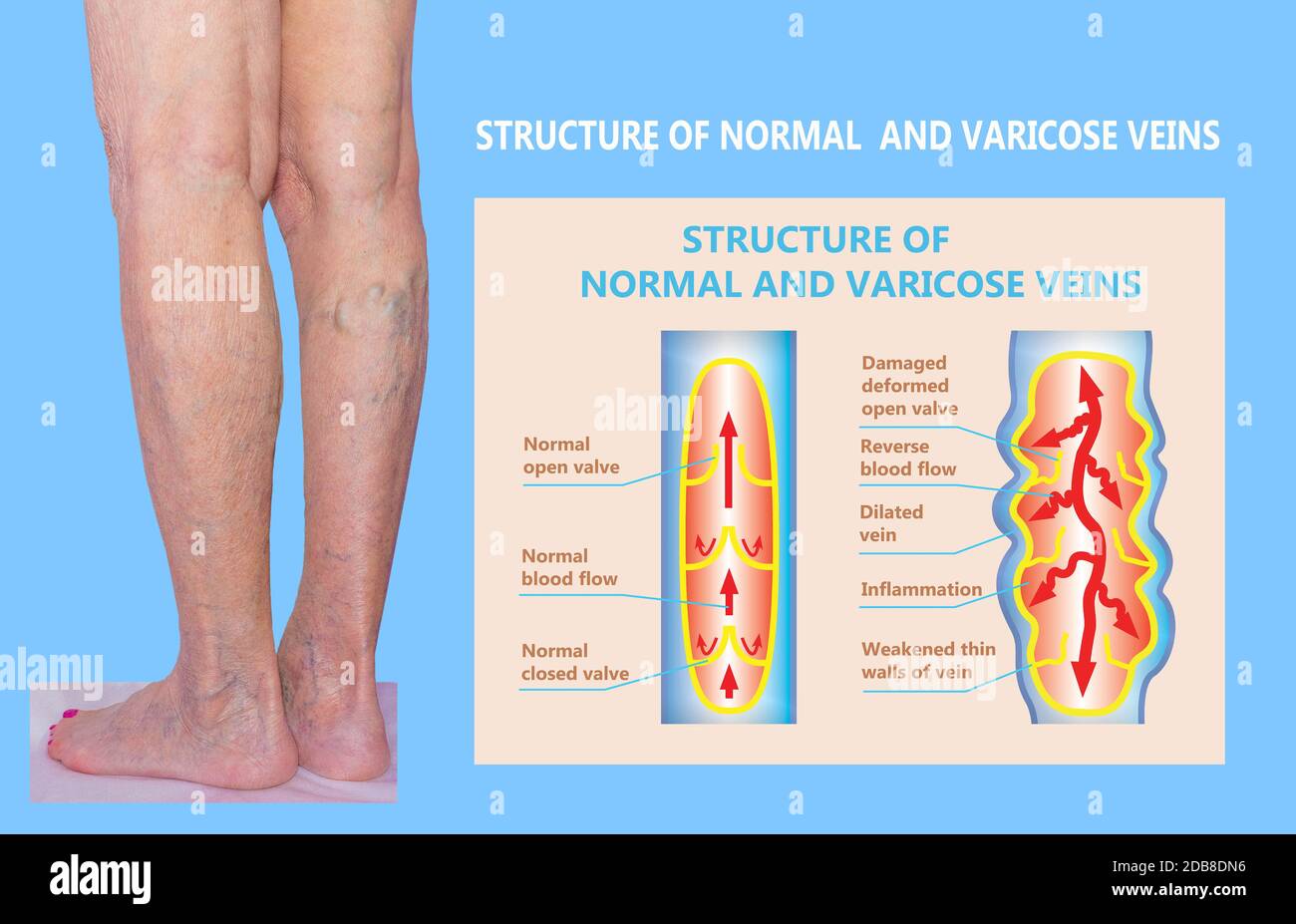 Varicose veins on a female senior legs. The structure of normal and ...