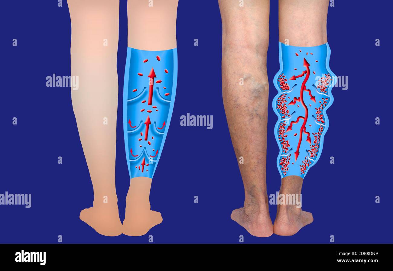 Varicose veins on a female senior legs. The structure of normal and ...