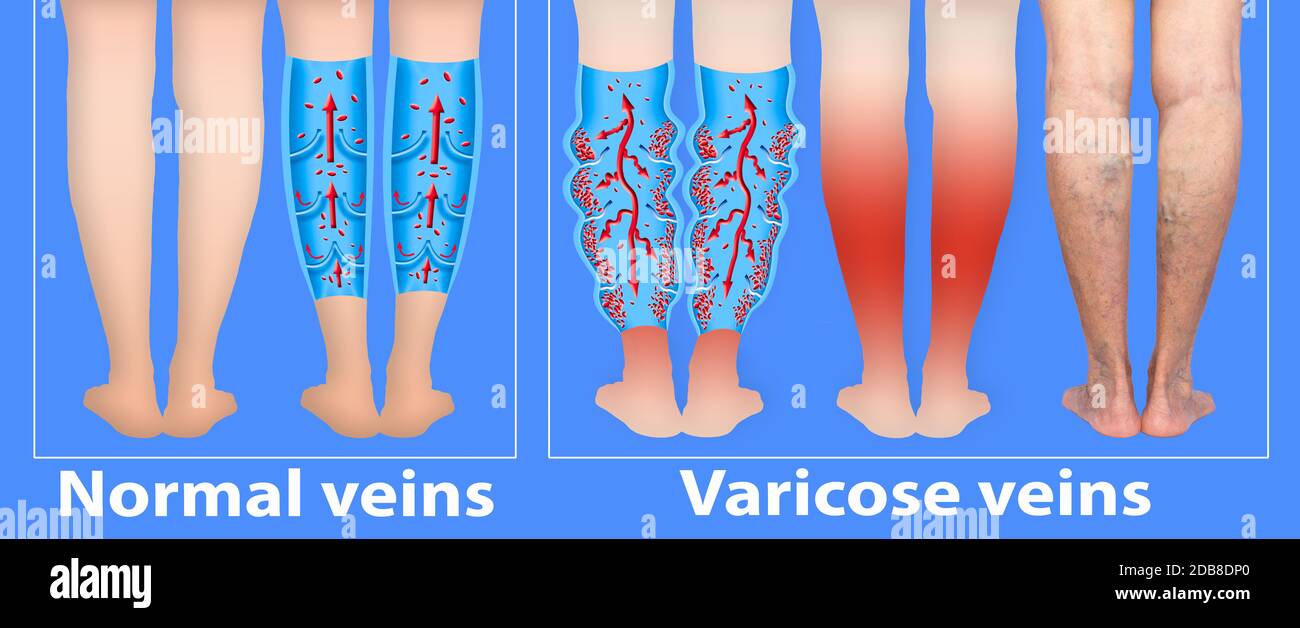 Varicose veins on a female senior legs. The structure of normal and ...