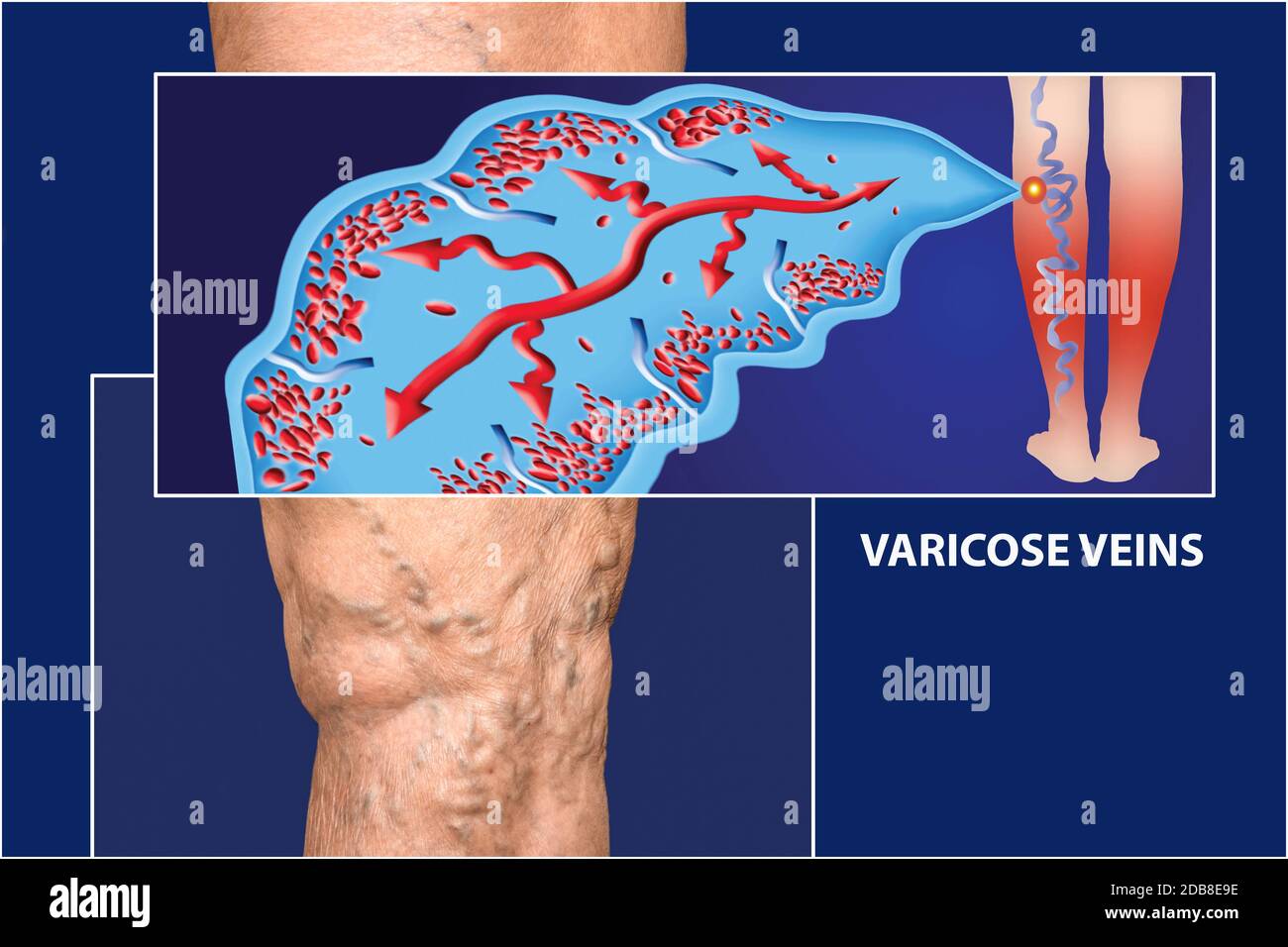 The old age and sick of a woman. Varicose veins on a legs of woman. The ...
