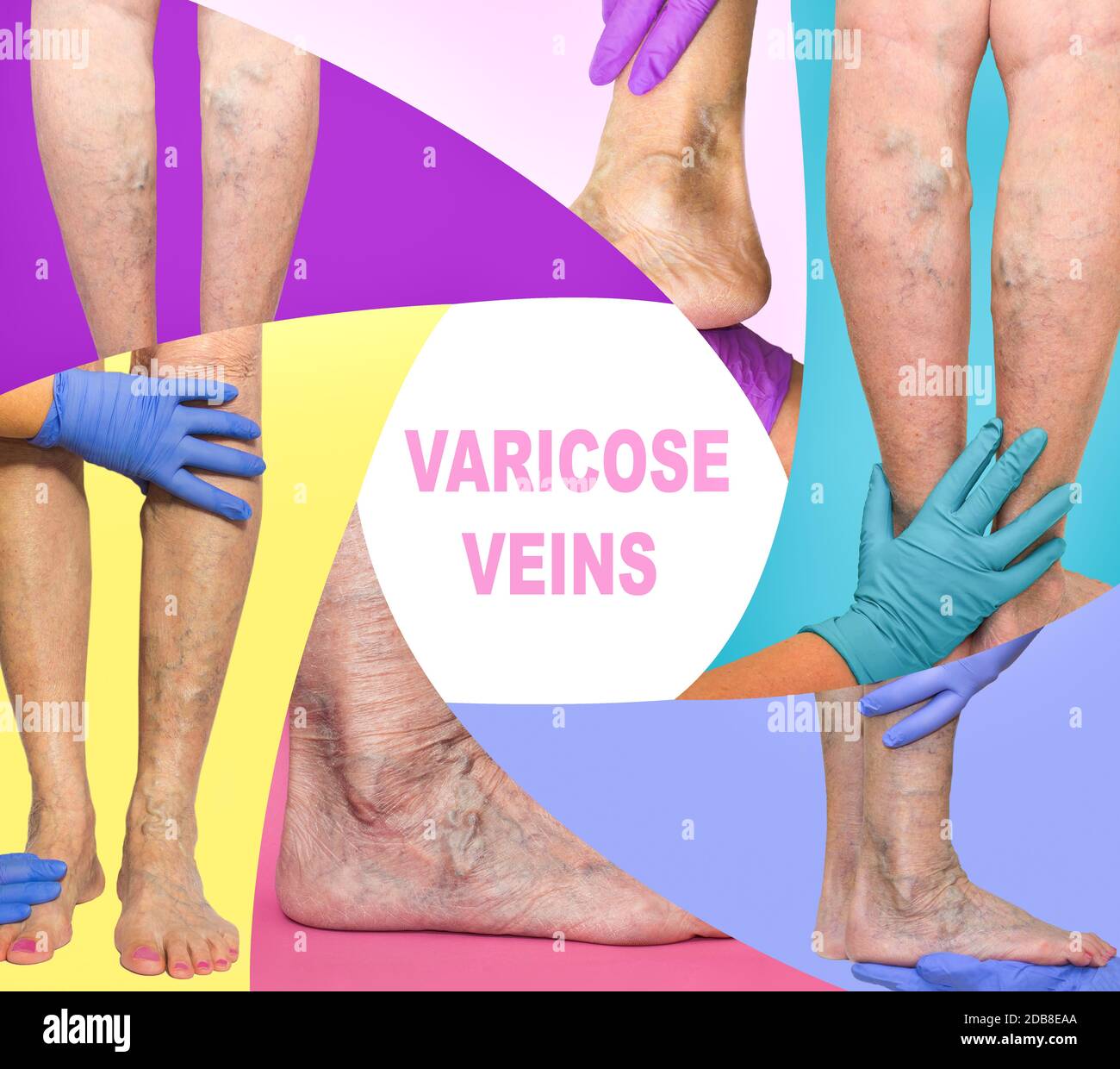 The female legs with veins varicose spider at studio. Collage. Lower ...
