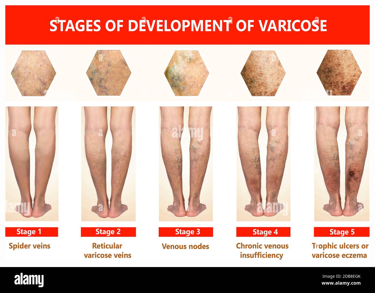 Varicose veins on a female senior legs. The stages of varicose veins ...