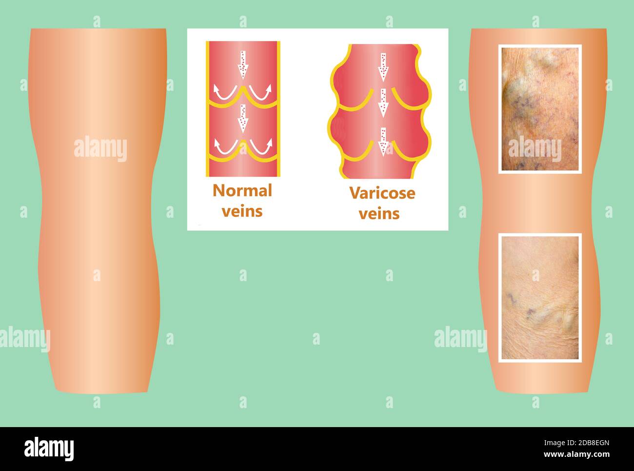 Varicose veins on a female senior leg. Collage about structure of ...