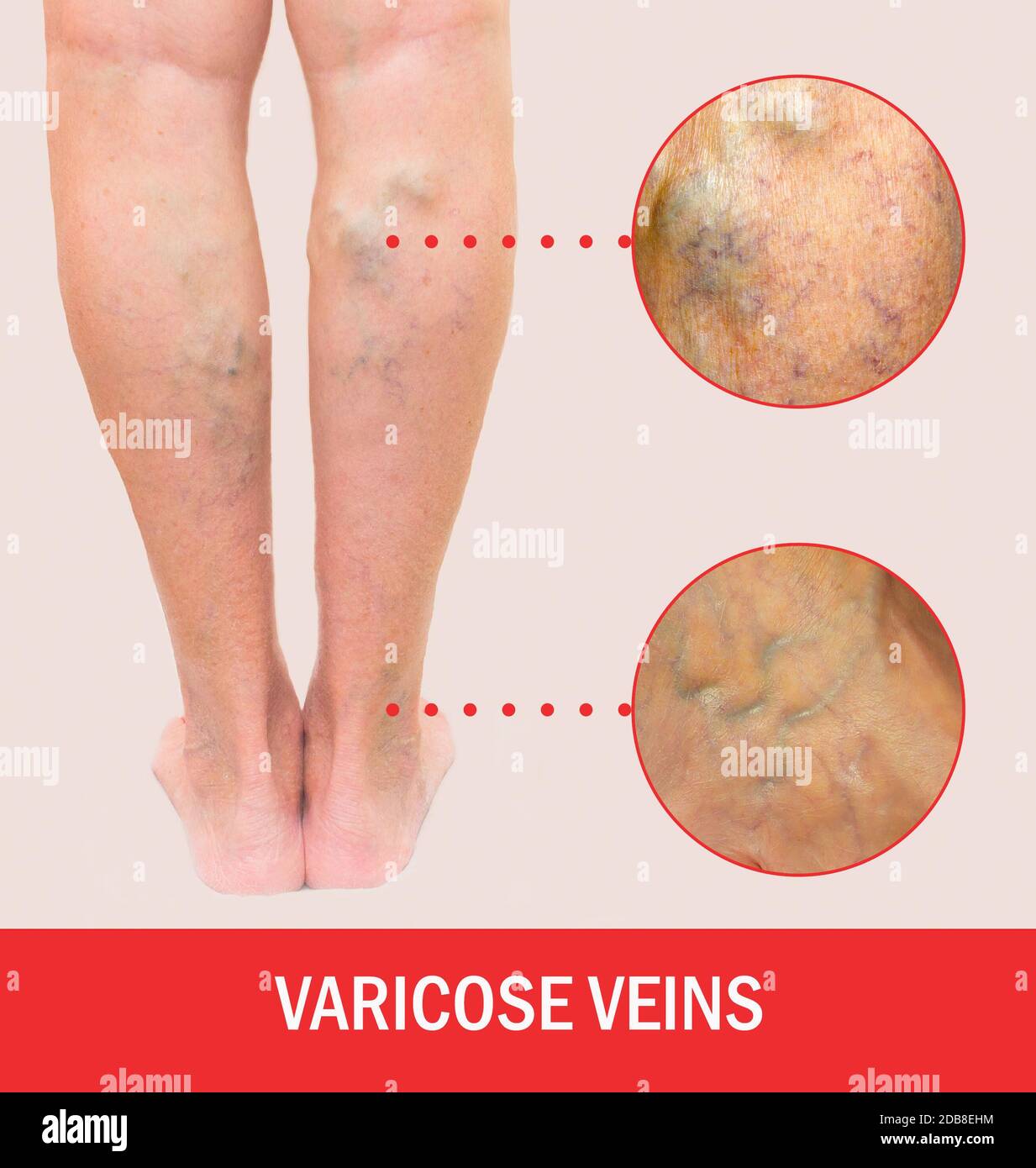 Painful varicose veins,,spider veins, varices on a female leg. Ageing ...