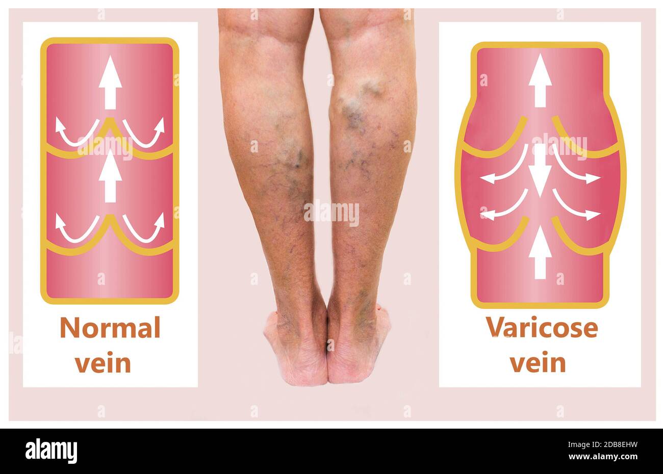 Tortuous vein Cut Out Stock Images & Pictures - Alamy