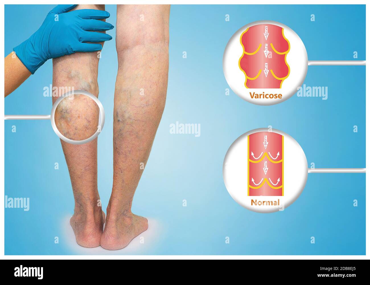 Varicose veins on a female senior legs. The structure of normal and ...