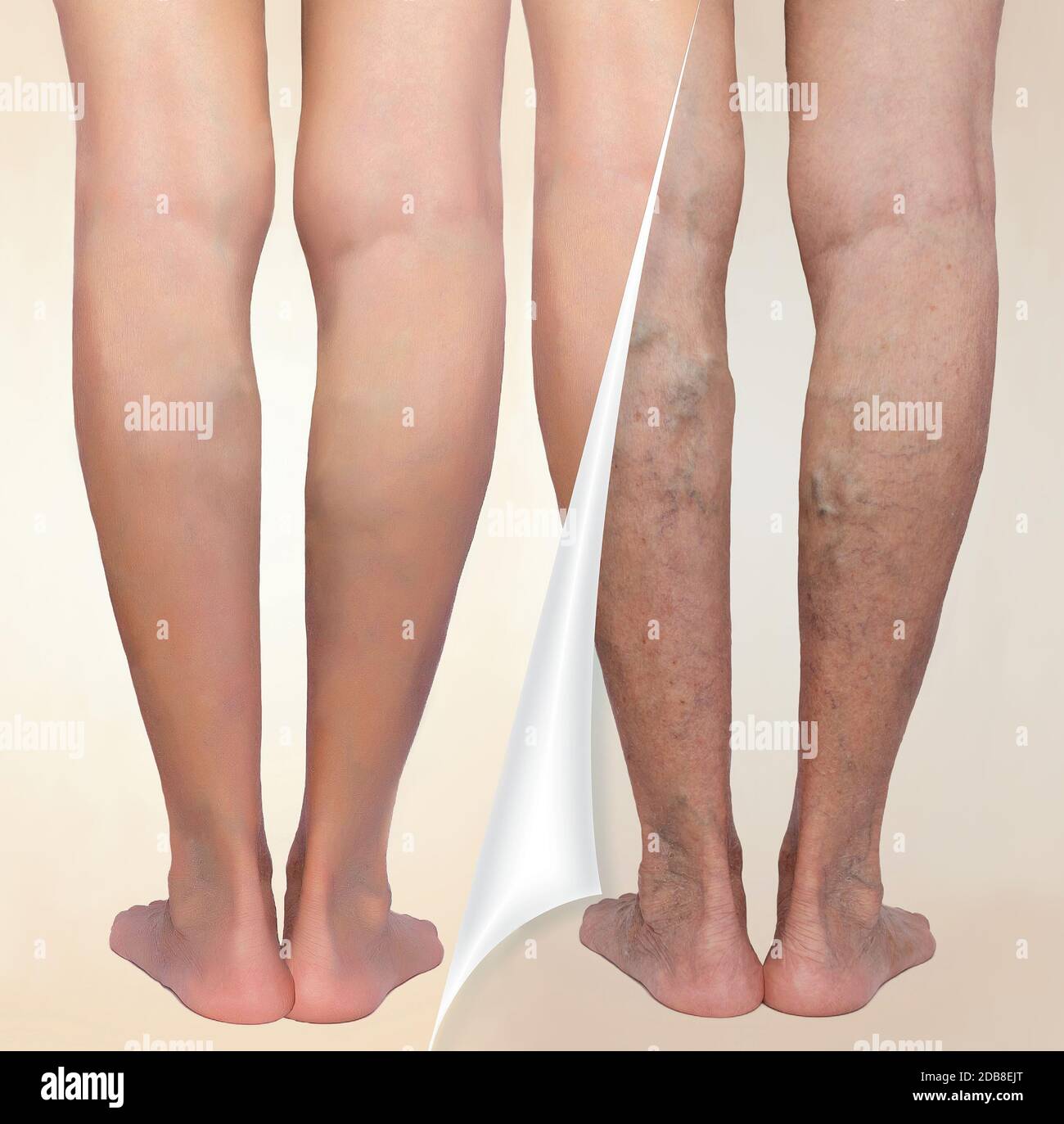Treatment of varicose before and after. Varicose veins on the senior ...