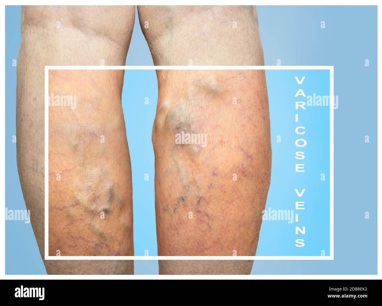 The varicose veins on female legs on blue background Stock Photo - Alamy