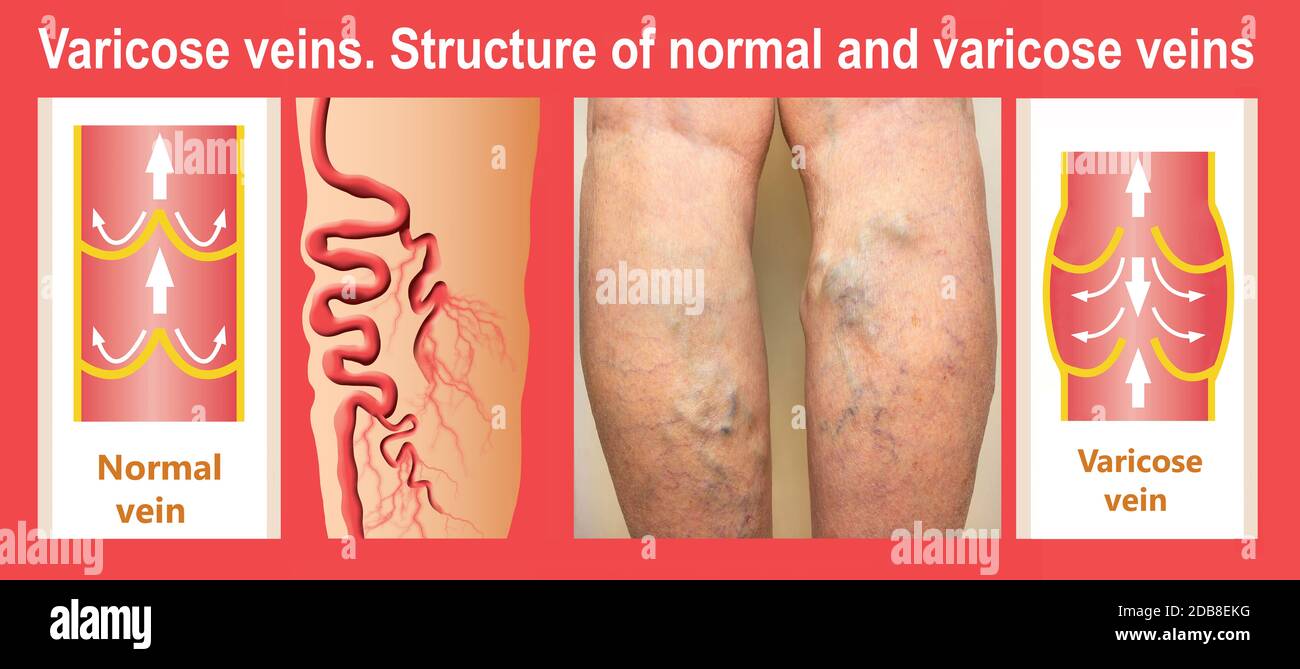 Varicose veins on a female senior leg. Collage about structure of ...