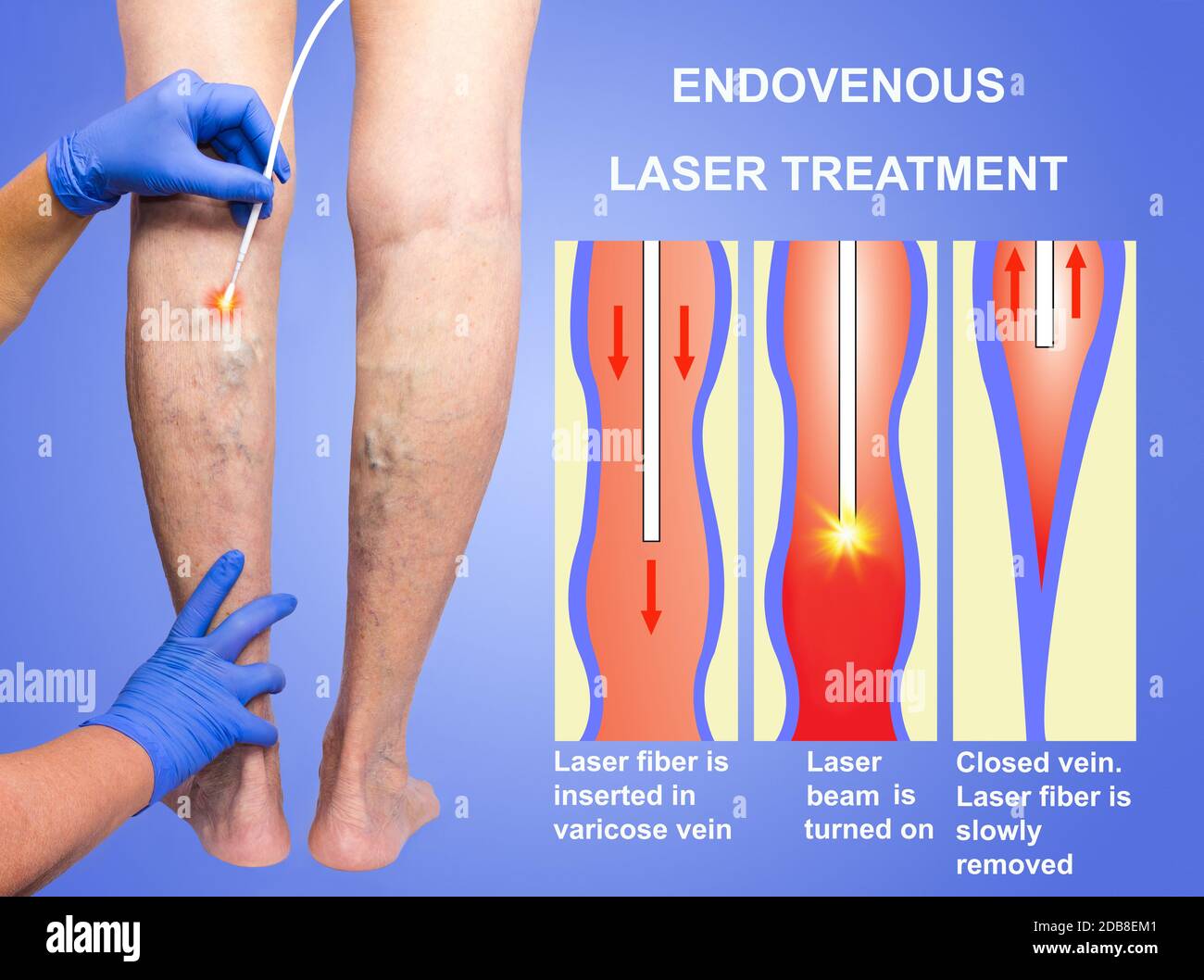 Varicose Veins. Endovenous laser treatment of female legs Stock Photo ...