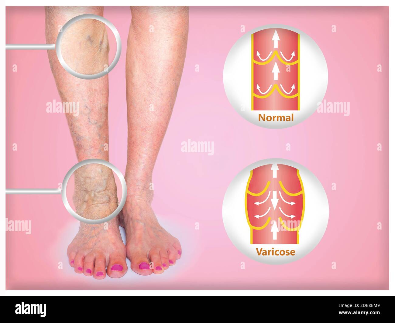 Varicose veins on a female senior legs. The structure of normal and ...