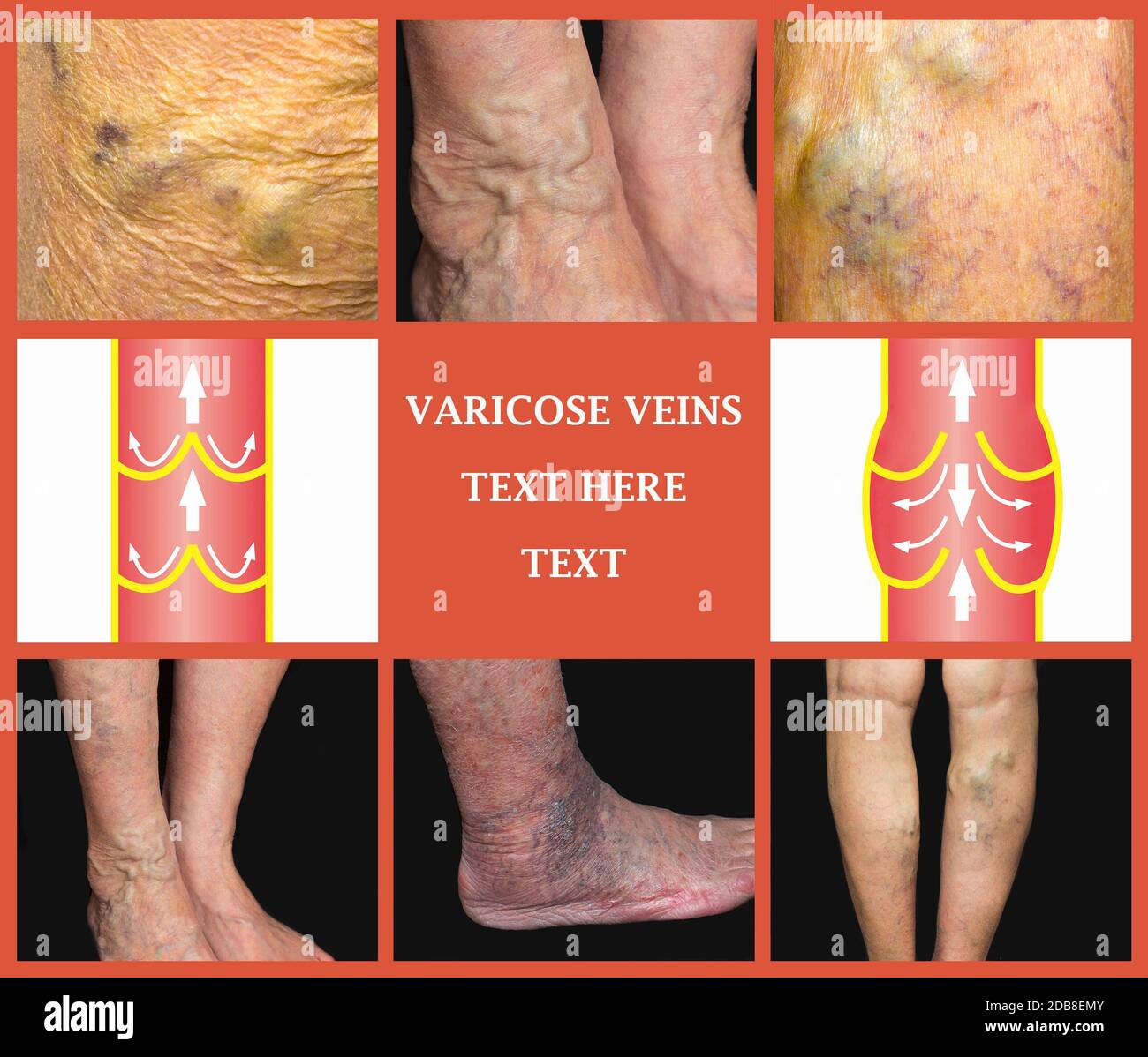 Varicose veins on a female and male senior legs. The structure of ...