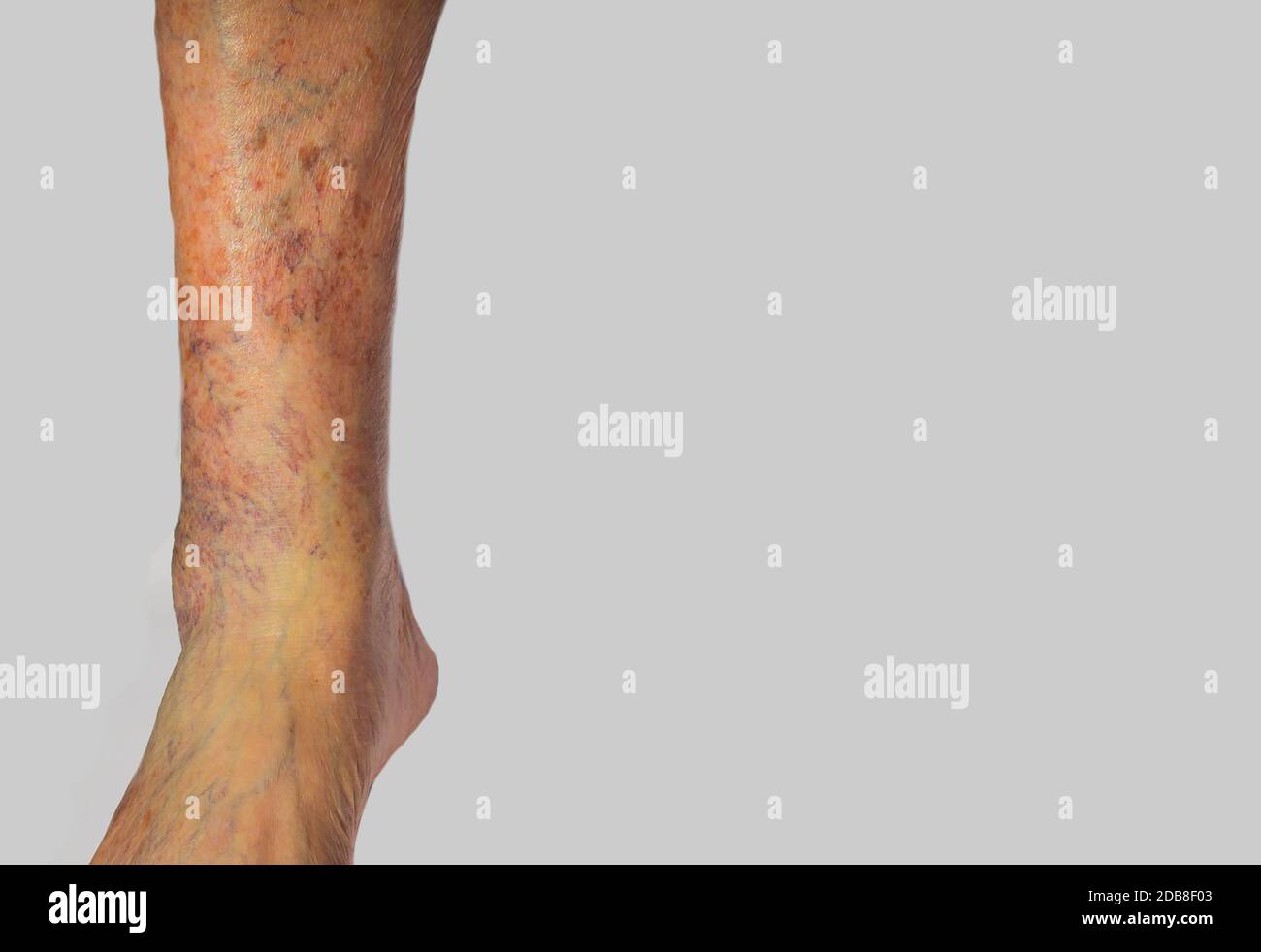 The varicose veins on a leg of old man on gray Stock Photo - Alamy