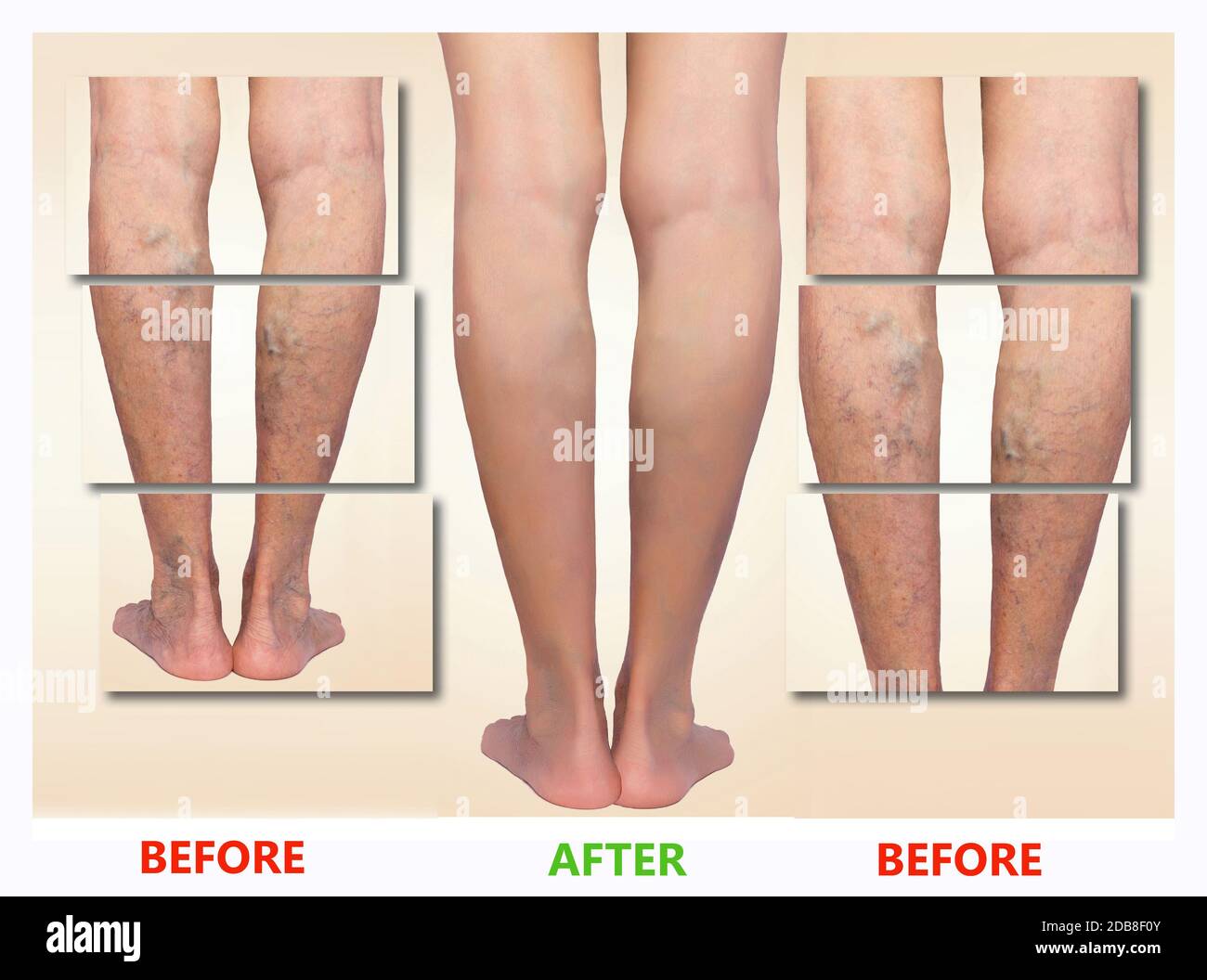 Treatment of varicose before and after. Varicose veins on the senior ...