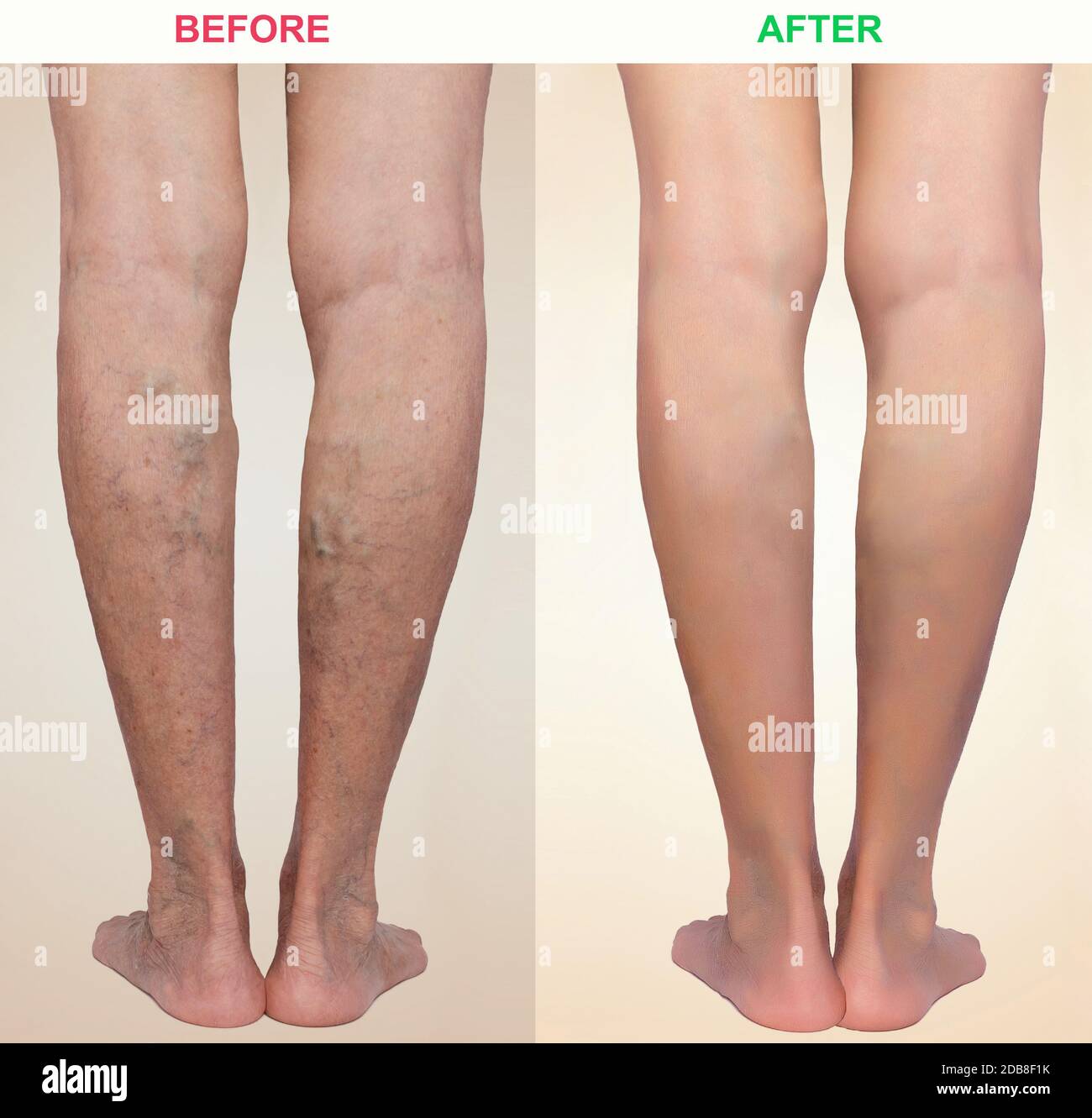Treatment of varicose before and after. Varicose veins on the senior ...