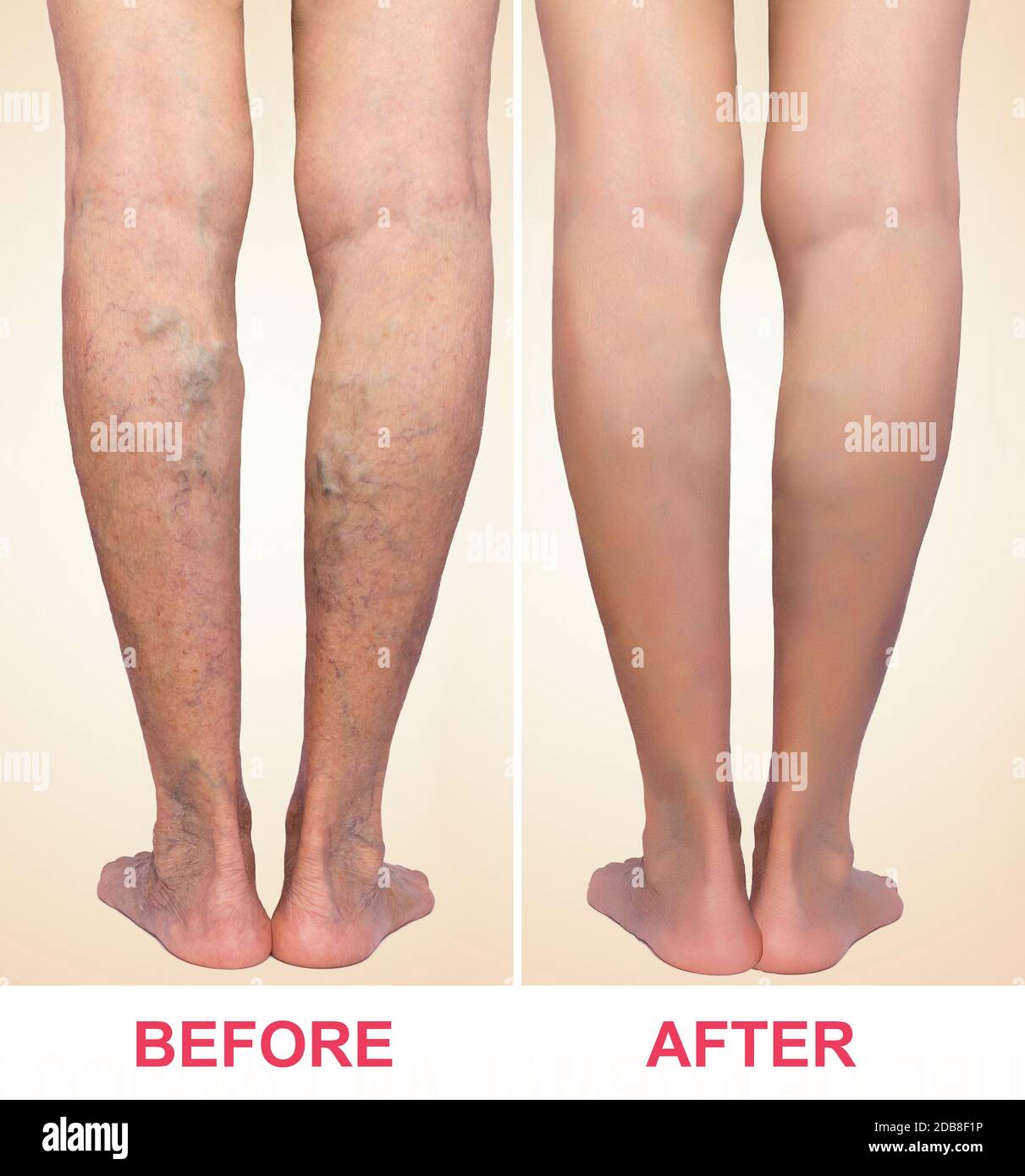 Treatment of varicose before and after. Varicose veins on the senior ...