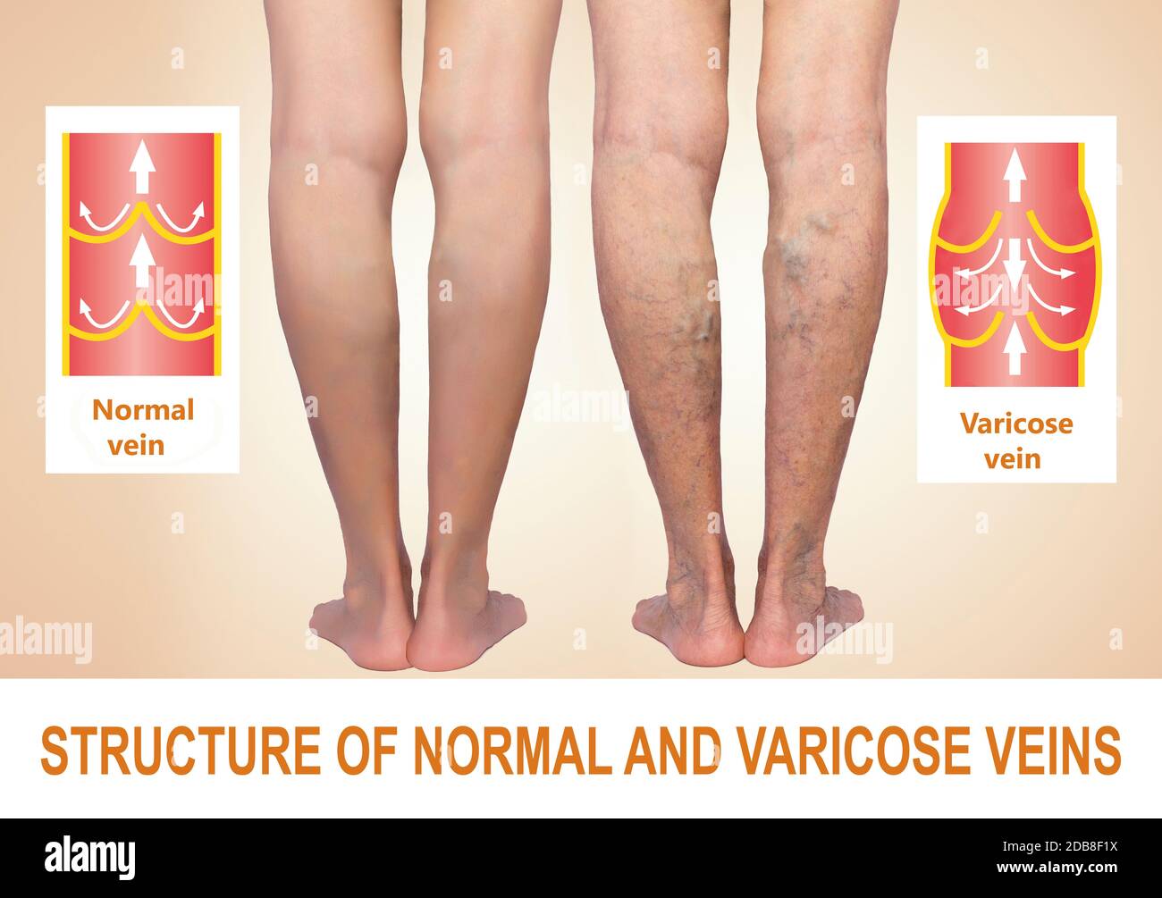 Varicose veins on a female senior legs. The structure of normal and ...