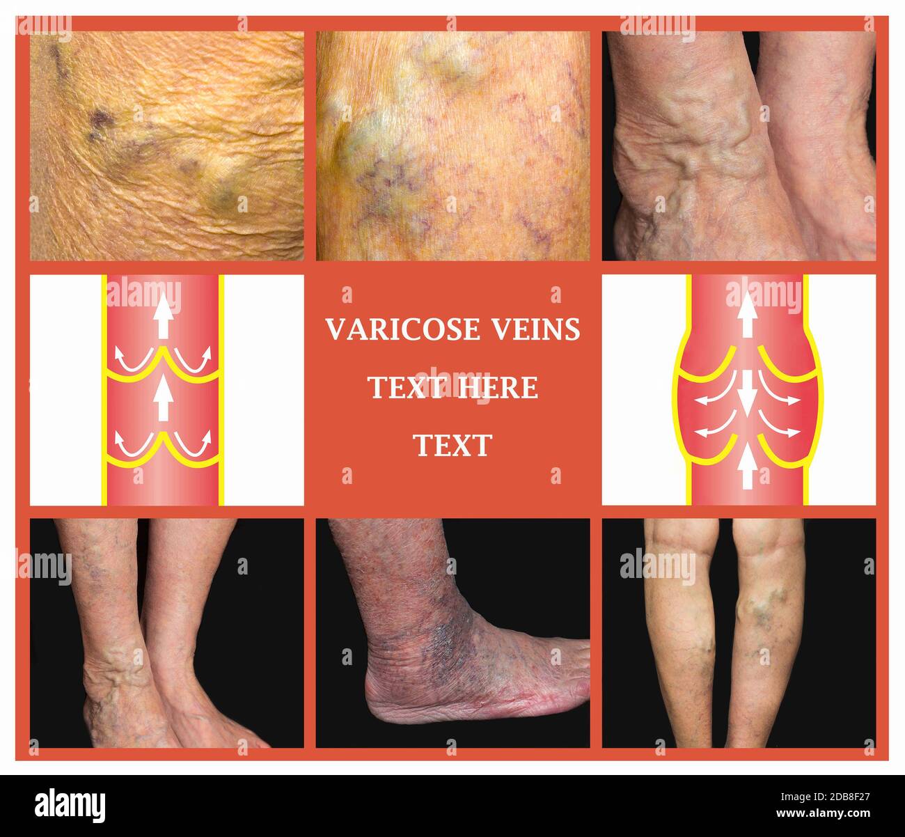 Varicose veins on a female senior legs. The structure of normal and ...