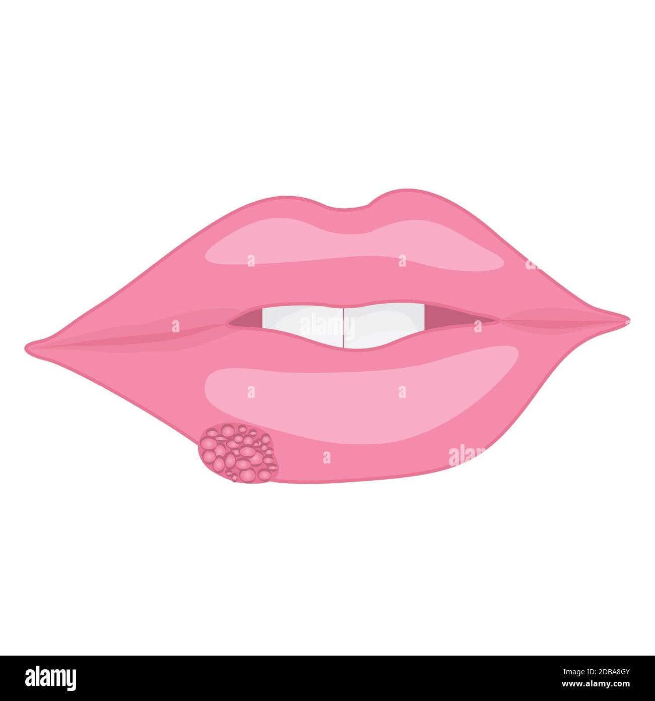 A mouth with Cold sores on lips vector illustration on a white ...