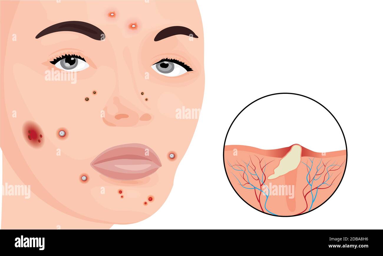 Acne on a woman face vector illustration Stock Photo - Alamy