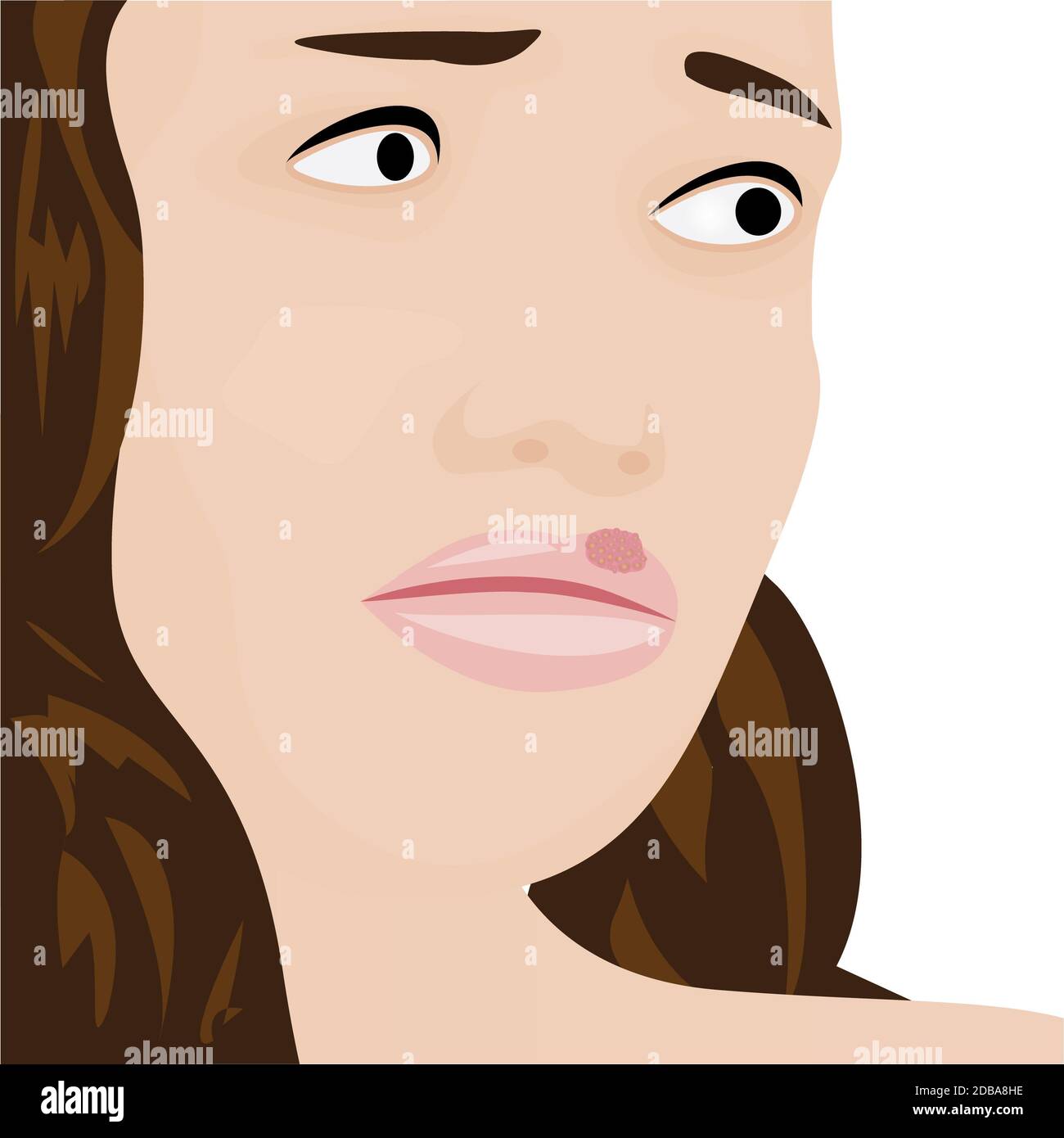 A young woman having cold sores herpes viral infection vector ...