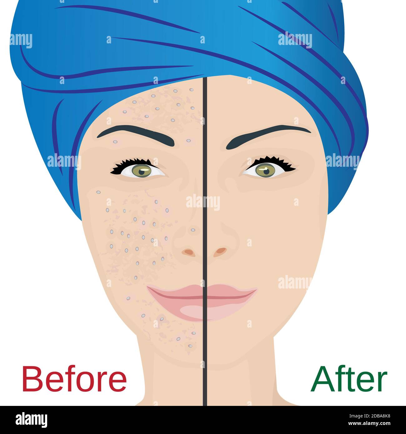 Acne pustules on a woman's face and a treatment result before and after ...