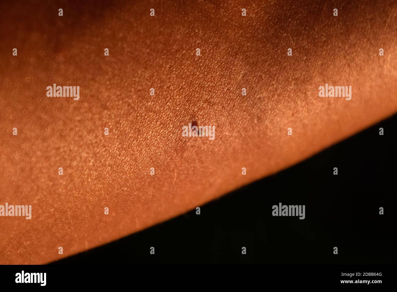 Bee sting skin hi-res stock photography and images - Alamy