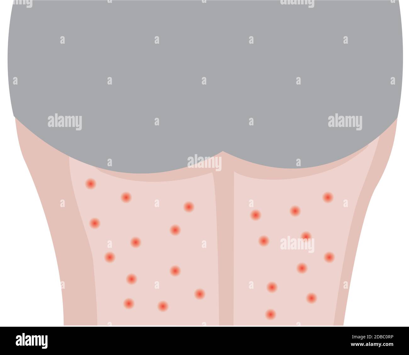 Person's legs affected with eczema skin disease vector illustration ...