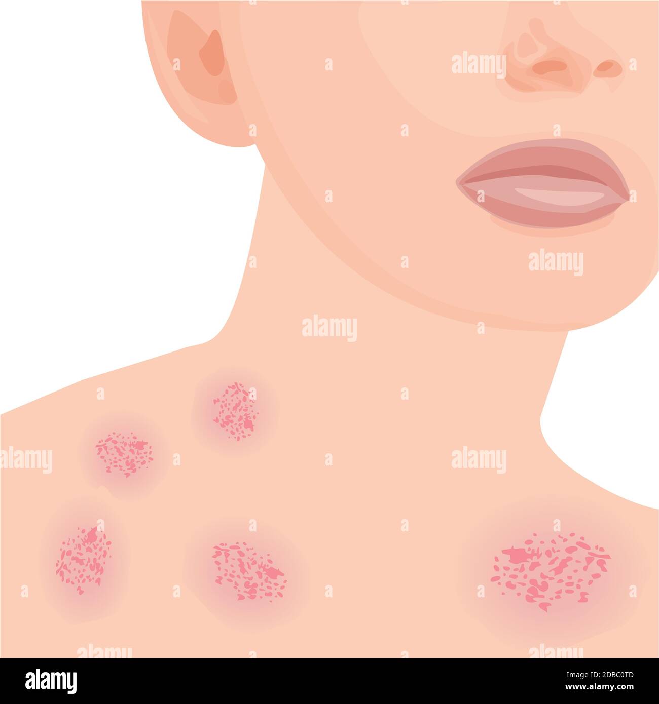 Eczema affected a body Dermatology skin disease concept vector ...